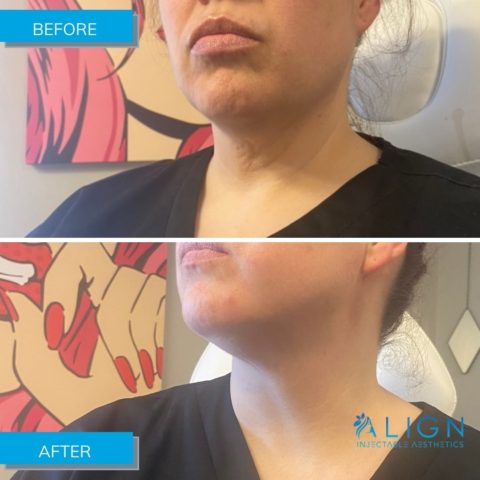 Before and After Non-Surgical Neck Treatment | Align Injectable Aesthetics